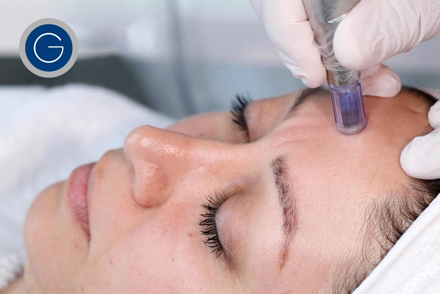 Innovative Goldeneye micro-needling technique